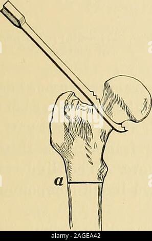 Along the spine, a four inch incision site is shown the day after a ...