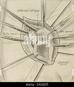 EPIDURAL ANESTHESIA, DRAWING Stock Photo - Alamy