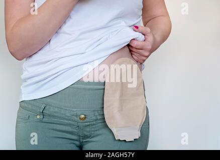 Colostomy bag in skin color attached to young woman patient. Close-up ...