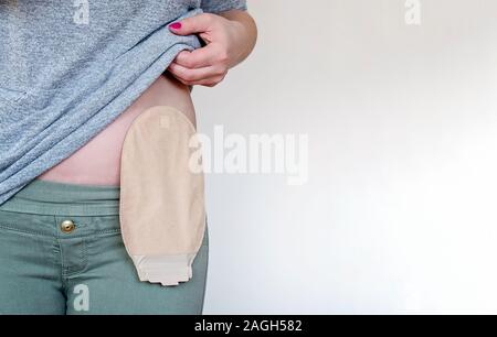 Colostomy bag in skin color attached to young woman patient. Close-up ...