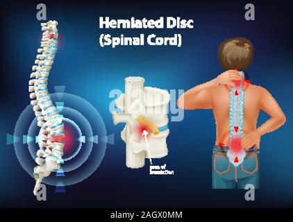 Diagram showing herniated Disc illustration Stock Vector Image & Art ...