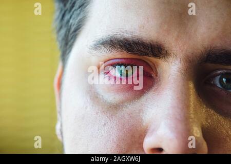 Close-up of a meibomian abscess with pus (yellow) in the eyelid of a 71 ...