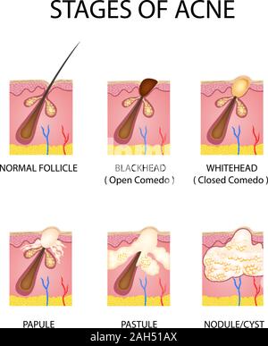 Stages of skin acne anatomy illustration Stock Vector Image & Art - Alamy