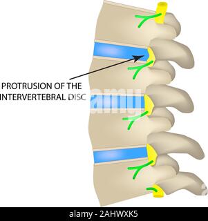 Stages of disc herniation spine and disc anatomy 3d medical vector ...