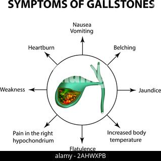 Illustration of Human gallbladder anatomy. Dyskinesia of the biliary ...