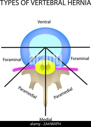 Vector illustration types of lumbar intervertebral disc herniation ...