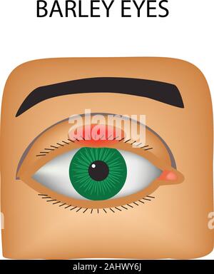 Barley eyes. Purulent inflammation. The structure of the eye ...