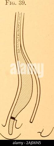 A manual of diseases of the nose and throat . of cartilage and bone ...