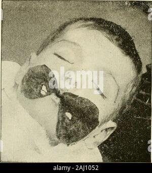 Modern surgery, general and operative . fail, try the overcurved ...