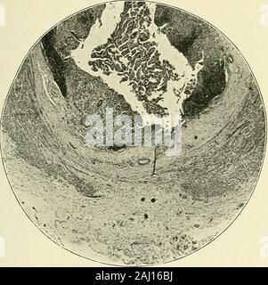 Appendicitis : its pathology and surgery . -Ulceration of the mucosa ...