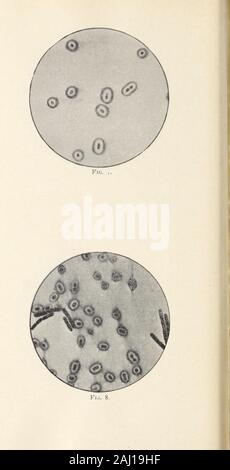 Mt Sinai Hospital Reports . Fig 6 Papillary carcinoma, showing atypical ...