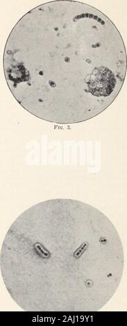 Mt Sinai Hospital Reports . Fig 6 Papillary carcinoma, showing atypical ...