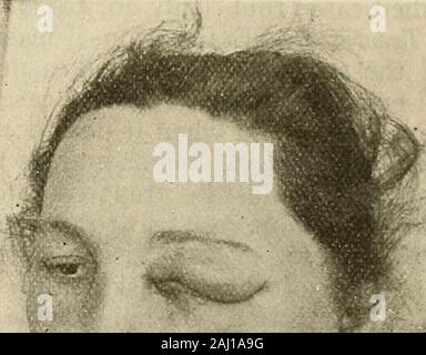 Modern surgery, general and operative . dusky skin above it (Fig. 161 ...