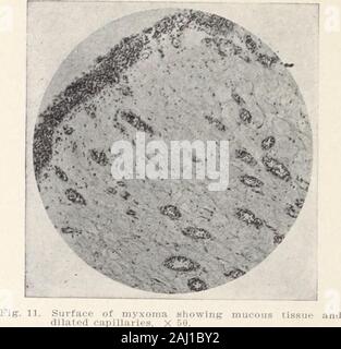 Mt Sinai Hospital Reports . Fig 6 Papillary carcinoma, showing atypical ...