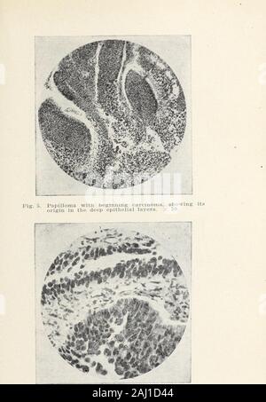 Mt Sinai Hospital Reports . Fig 6 Papillary carcinoma, showing atypical ...