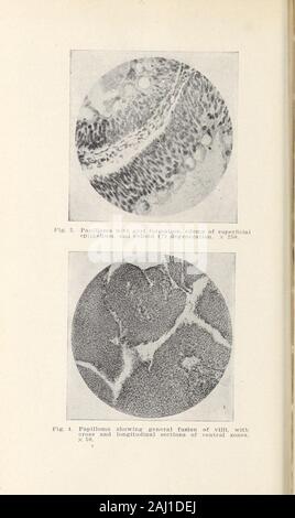 Mt Sinai Hospital Reports . Fig 6 Papillary carcinoma, showing atypical ...