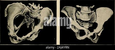 A manual of obstetrics . 5 ti Abnormalities of the female pelvis ...