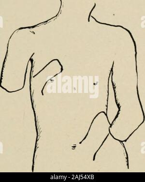 Amputation stump with tattoo Stock Photo - Alamy