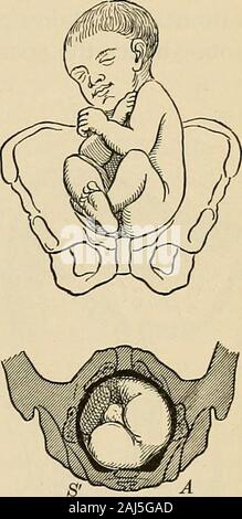 Fetal breech presentation Stock Photo - Alamy