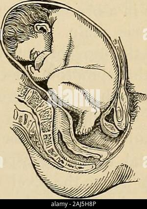 Fetal breech presentation Stock Photo - Alamy