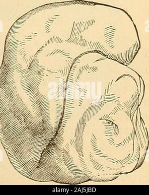 Lipoma. Lipoma in adipose (fat) tissue removed from a patient. Lipomas ...