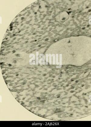 Some points in the anatomy, pathology, and surgery of intussusception ...