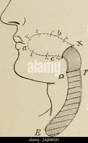 Plastic surgery; its principles and practice . end of the double flap ...