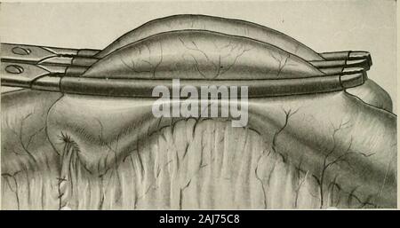 Blood vessels: suture between two arteries during a transplant Stock ...