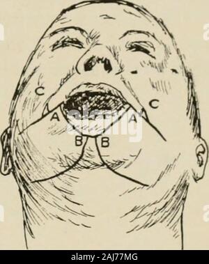 Plastic surgery; its principles and practice . and is sutured into the ...