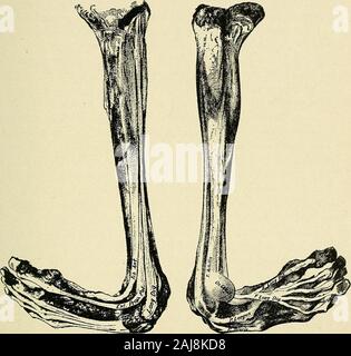 A treatise on orthopedic surgery . Talipes calcaneus due to paralysis ...