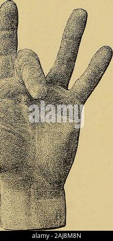 On contractions of the fingers (Dupuytren's and congenital contractions ...