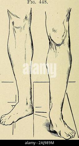 A treatise on orthopedic surgery . Illustrating the range of normal ...