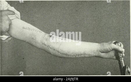 . Annals of surgery. Condition of forearm immediately previous to ...