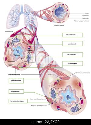 Bronchoconstriction in the lungs. Illustration of lung bronchioles and ...