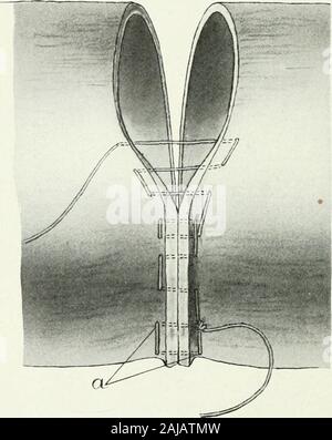Annals of surgery . Fig. 4.—Suture of complete transverse woutul ; A ...