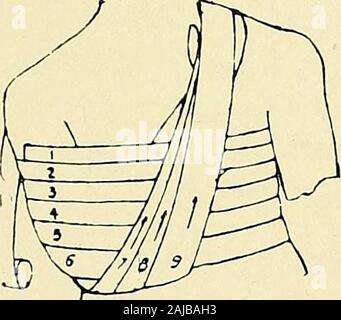 The principles and practice of bandaging : by Gwilym G Davis . Two ways ...