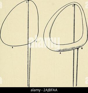 A treatise on orthopedic surgery . Forcible extension of the thigh ...