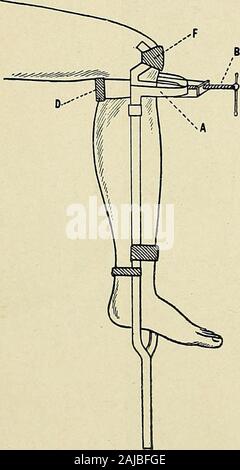 A treatise on orthopedic surgery . The genu varum type of bow-leg ...
