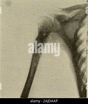 Arm bone after surgery, X-ray Stock Photo - Alamy