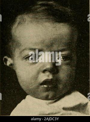The diseases of infants and children . the 1st year may ...
