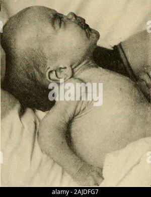 The diseases of infants and children . as in Fig. 196. is not due to an ...