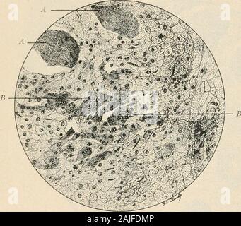 COLD ABSCESS, TUBERCULOSIS Stock Photo - Alamy