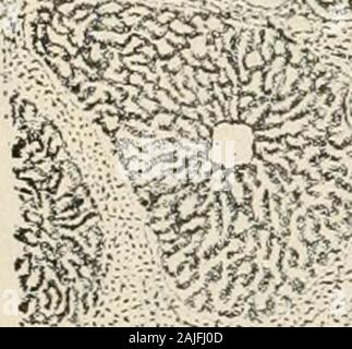 Liver: miliary tuberculosis Stock Photo - Alamy