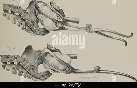 The principles and practice of obstetrics . position ofClanForceps at ...
