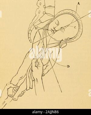A manual of practical obstetrics . Traction with axis-traction forceps ...