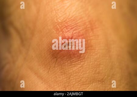 NECROSIS OF THE SKIN Stock Photo - Alamy