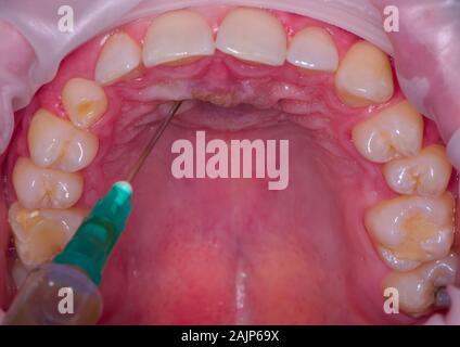 Needle aspiration of Incisive canal cyst Stock Photo - Alamy