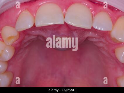 Needle aspiration of Incisive canal cyst Stock Photo - Alamy