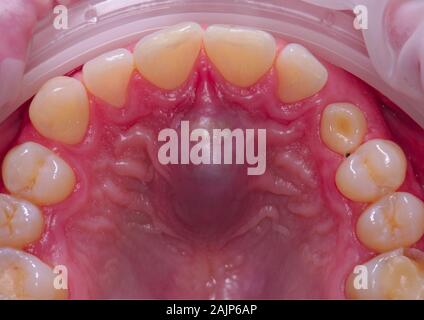 Needle aspiration of Incisive canal cyst Stock Photo - Alamy