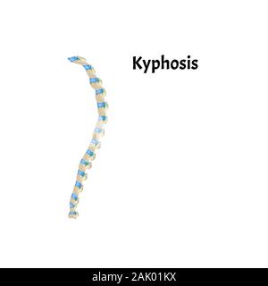The position of the spine with lordosis. Spinal curvature, kyphosis ...